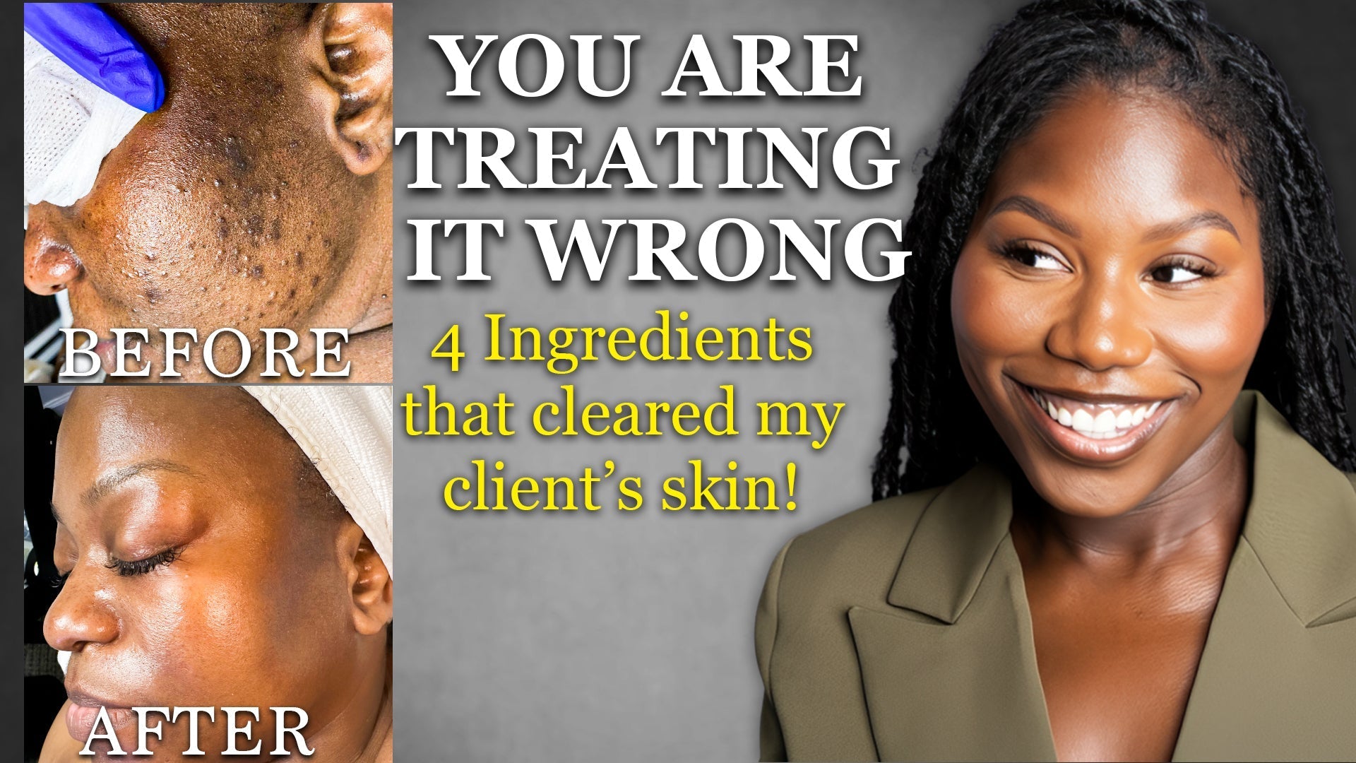 Stop Guessing What Works for Acne in 2026 – Blaq Label Esthetics